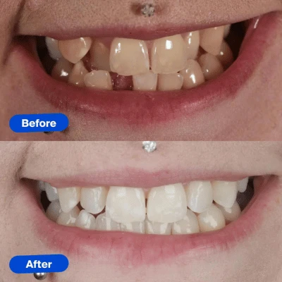 Smile Whites Clear Aligners Review