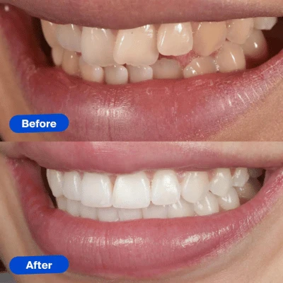Smile Whites Clear Aligners Review