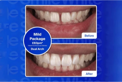 Smile Whites Clear Aligners Review