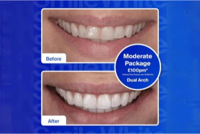 Smile Whites Clear Aligners Review