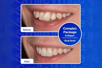 Smile Whites Clear Aligners Review