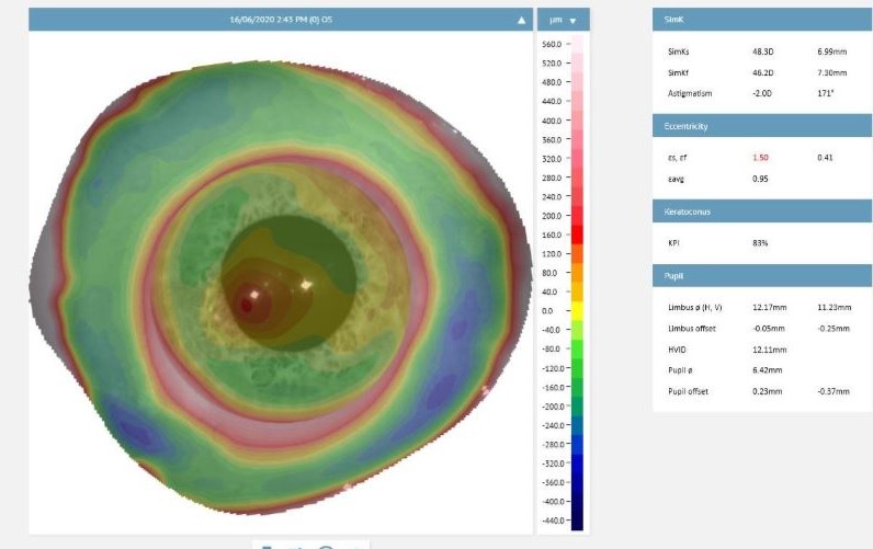Corneal Topography in Eye Health | Innovative Eye Care
