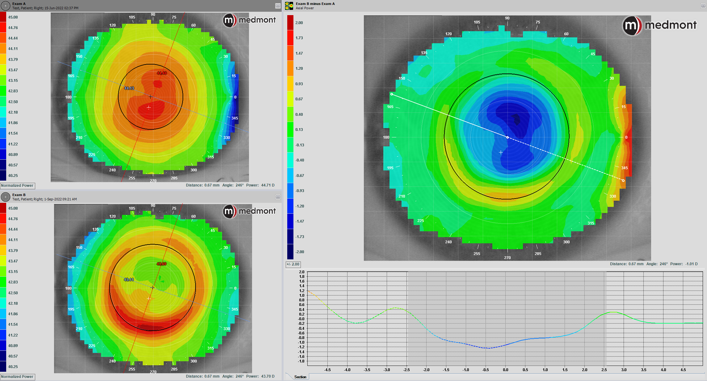 Corneal Topography in Eye Health | Innovative Eye Care