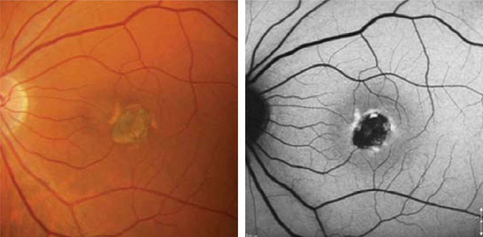 Fundus Autofluorescence Imaging | Innovative Eye Care