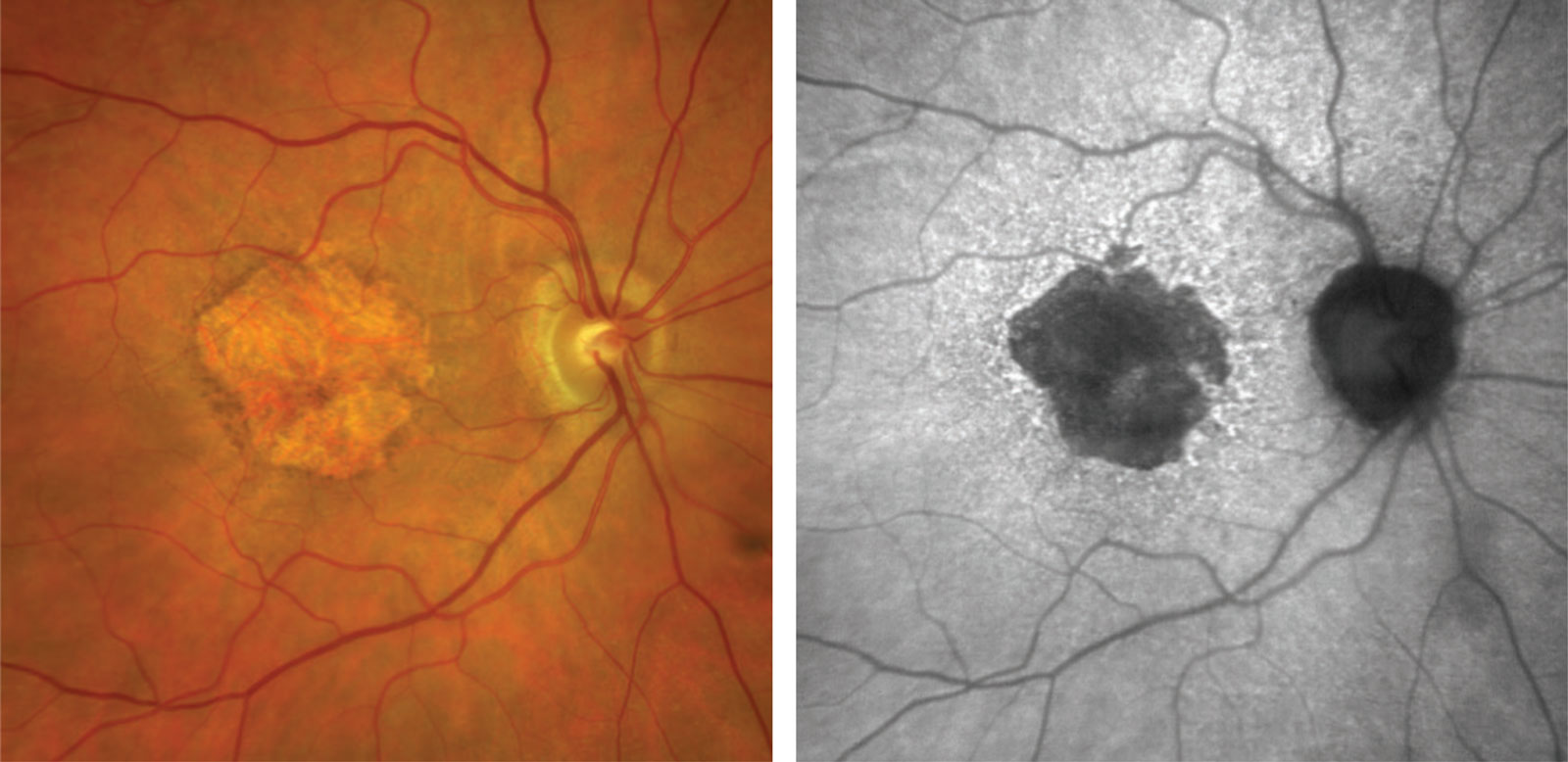Fundus Autofluorescence Imaging | Innovative Eye Care