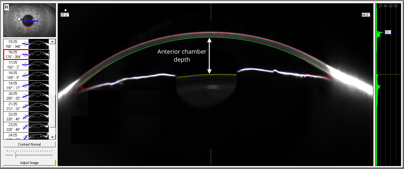 Optical and Ultrasound Biometry | Innovative Eye Care