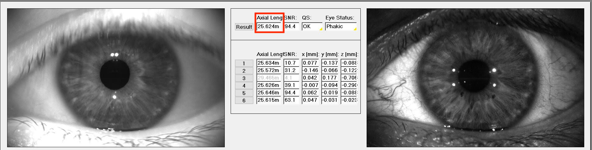 Optical and Ultrasound Biometry | Innovative Eye Care