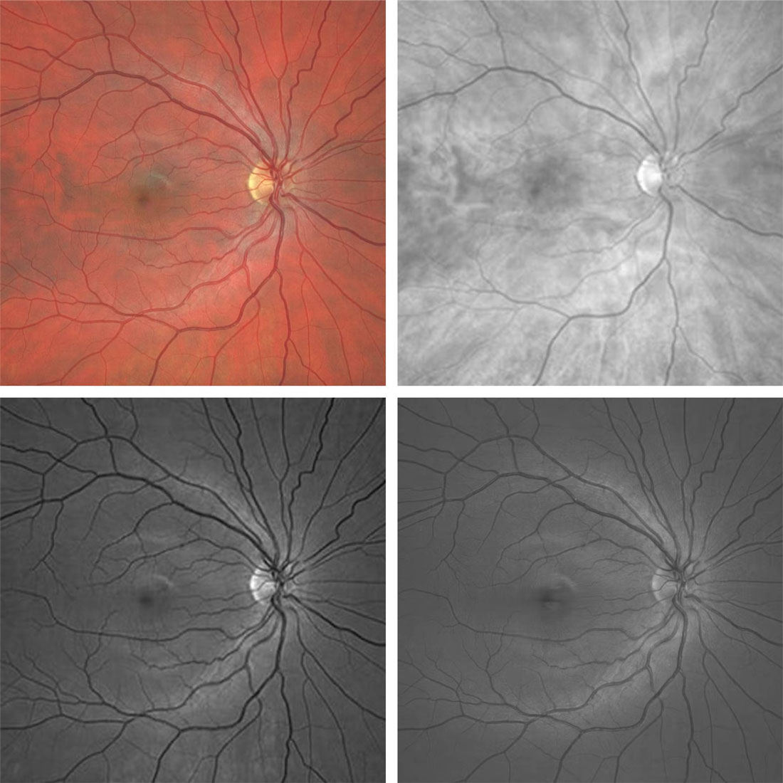 Advanced Retinal Imaging Techniques | Innovative Eye Care