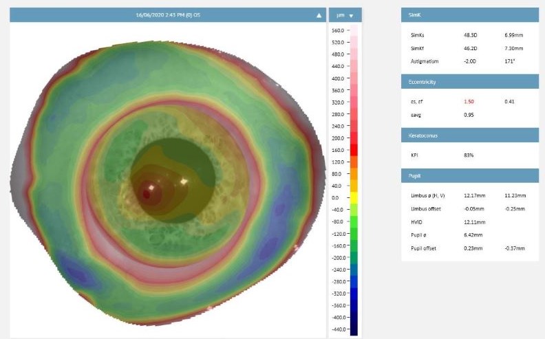 Scleral Contact Lens Fitting and Care | Innovative Eye Care
