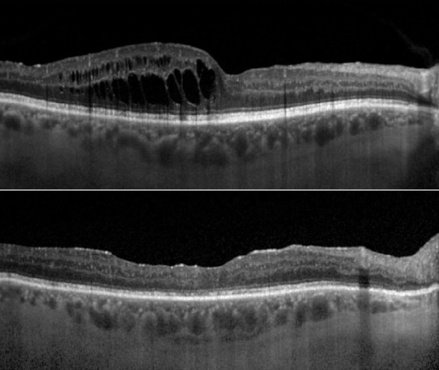 Diabetic Eye Disease | Innovative Eye Care