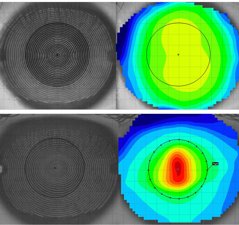 Keratoconus | Innovative Eye Care