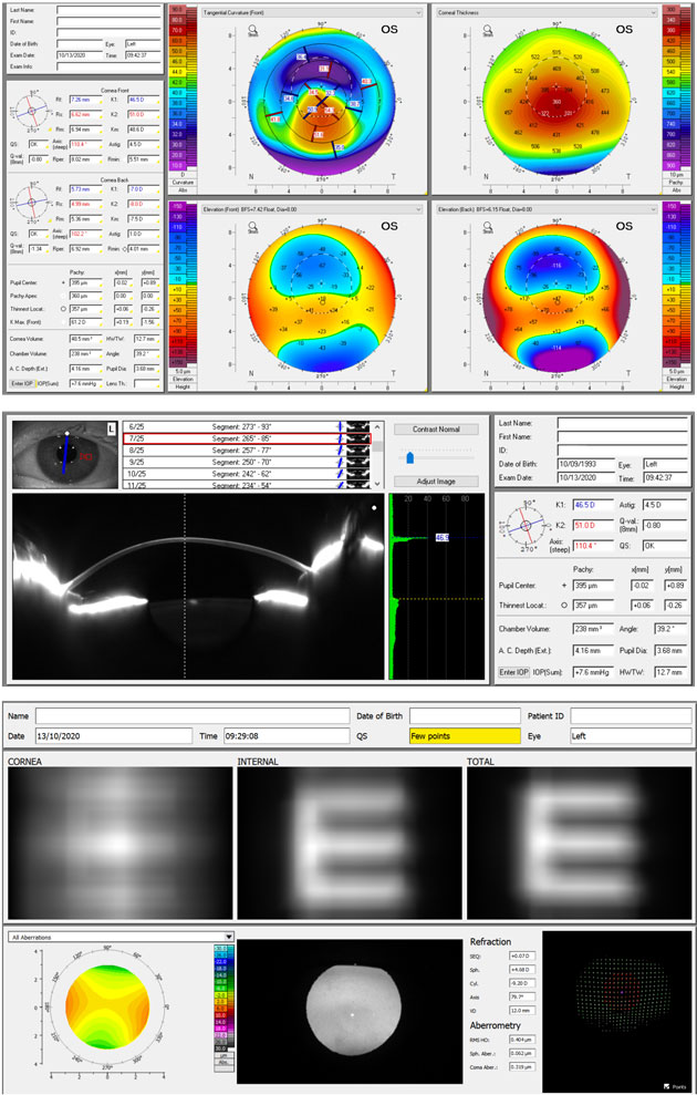 Keratoconus | Innovative Eye Care