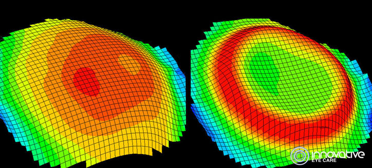 Night Lenses (OrthoK) | Innovative Eye Care