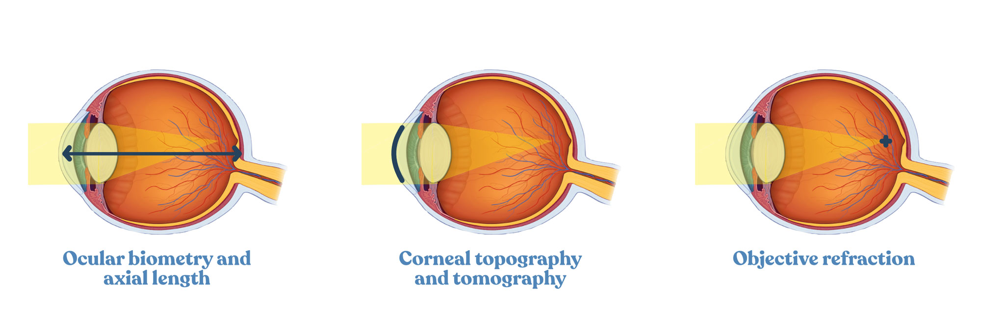 Myopia (Nearsightedness) Management | Innovative Eye Care