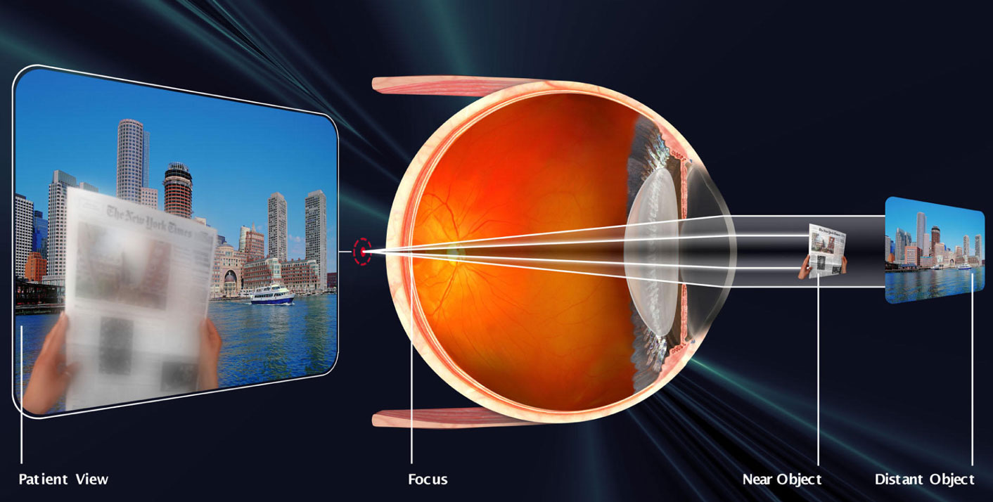 Presbyopia: Symptoms and Solutions | Innovative Eye Care