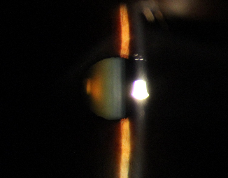 Keratoconus | Innovative Eye Care