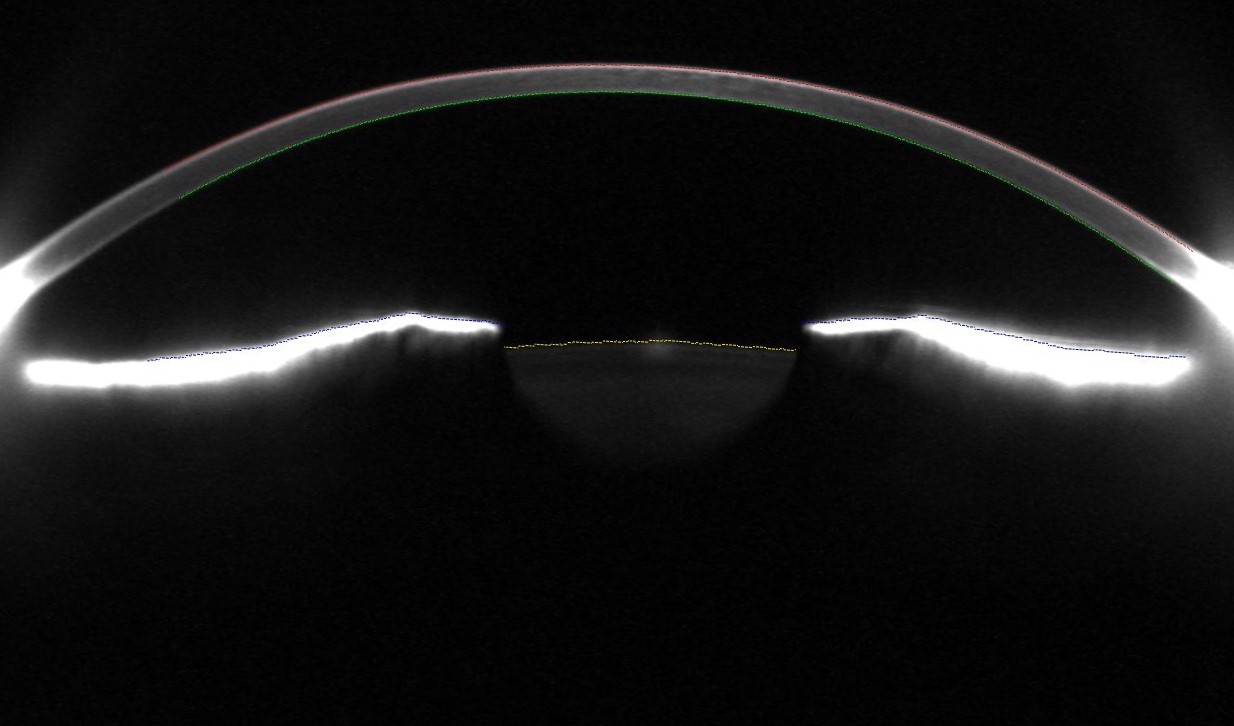 Corneal Tomography | Innovative Eye Care