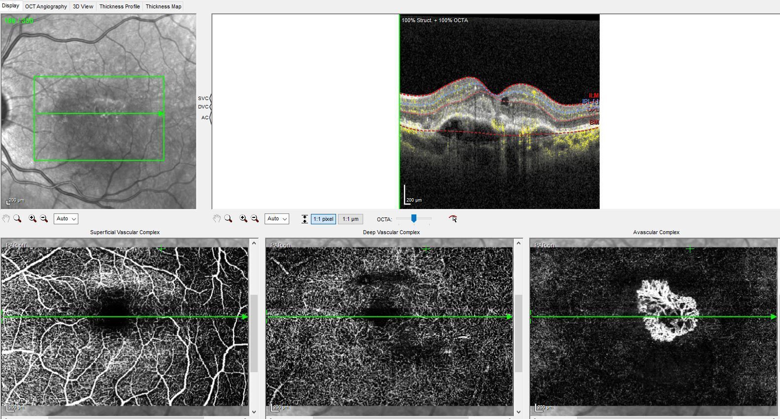 Macular Degeneration Diagnosis and Treatment | Innovative Eye Care