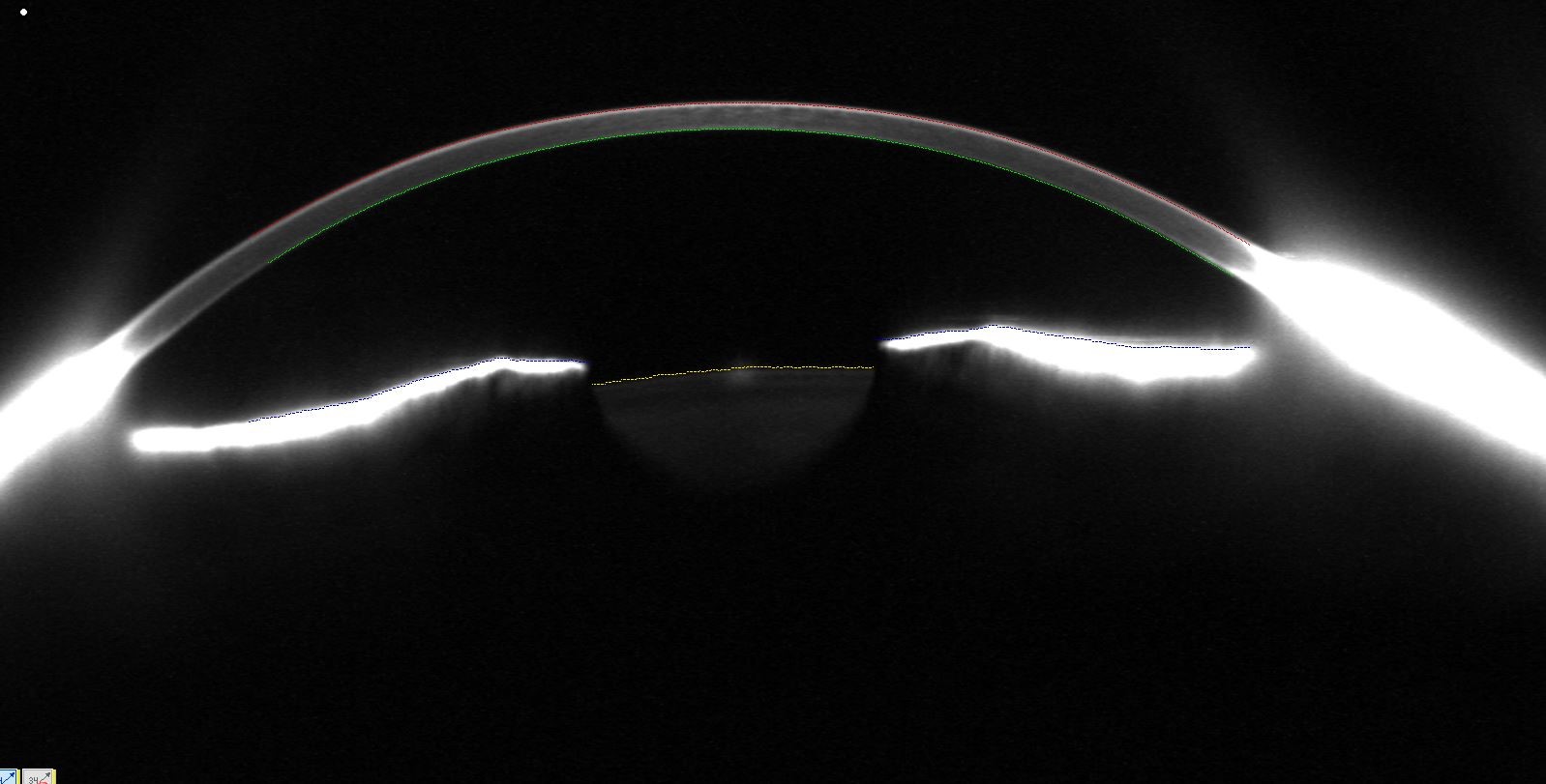 Corneal Tomography | Innovative Eye Care