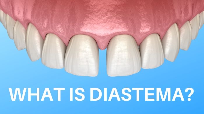 What is Diastema? – Straight My Teeth