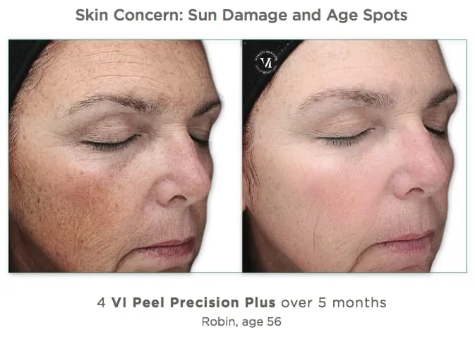Chemical Peels | Solcara Health | Mount Pleasant, SC