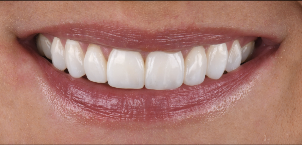 Composite Bonding - One Dental