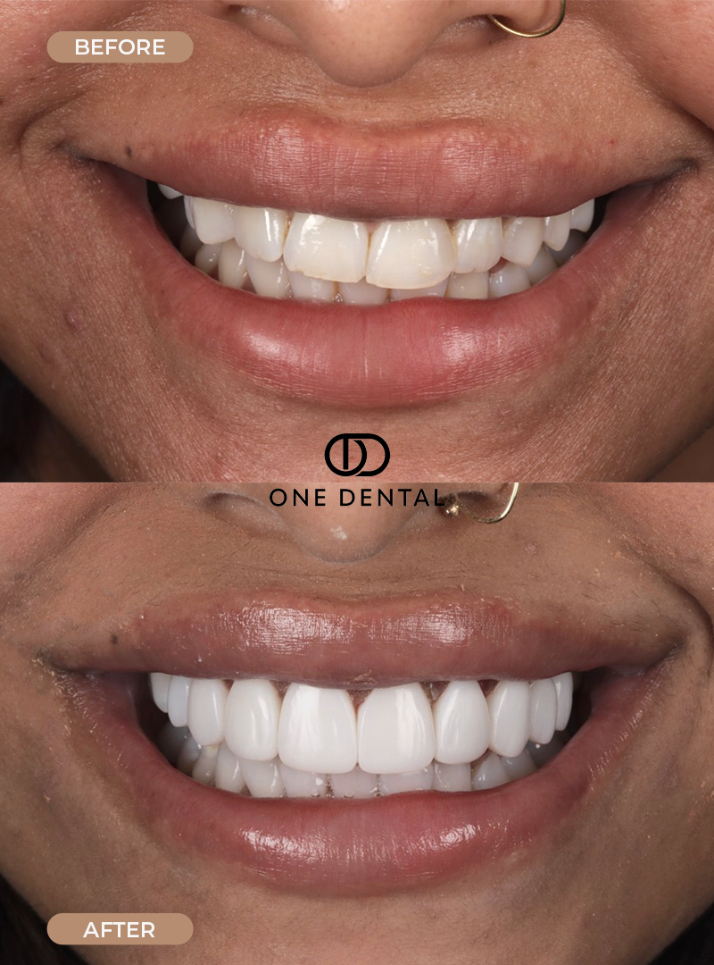 Composite Bonding - One Dental