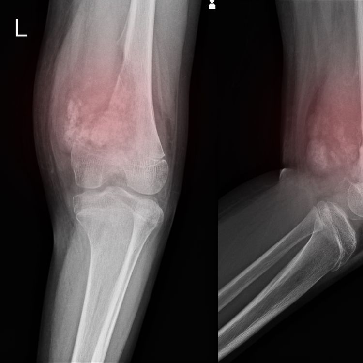 Osteosarcoma: Understanding the Condition, Symptoms and Diagnosis