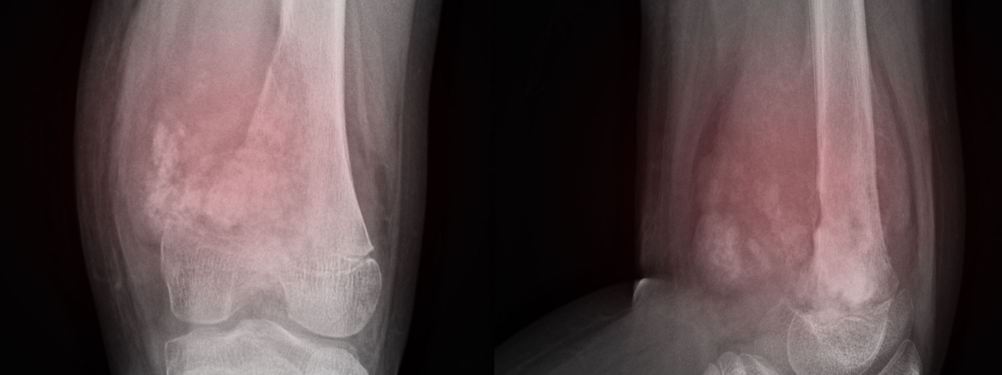 Osteosarcoma: Understanding the Condition, Symptoms and Diagnosis