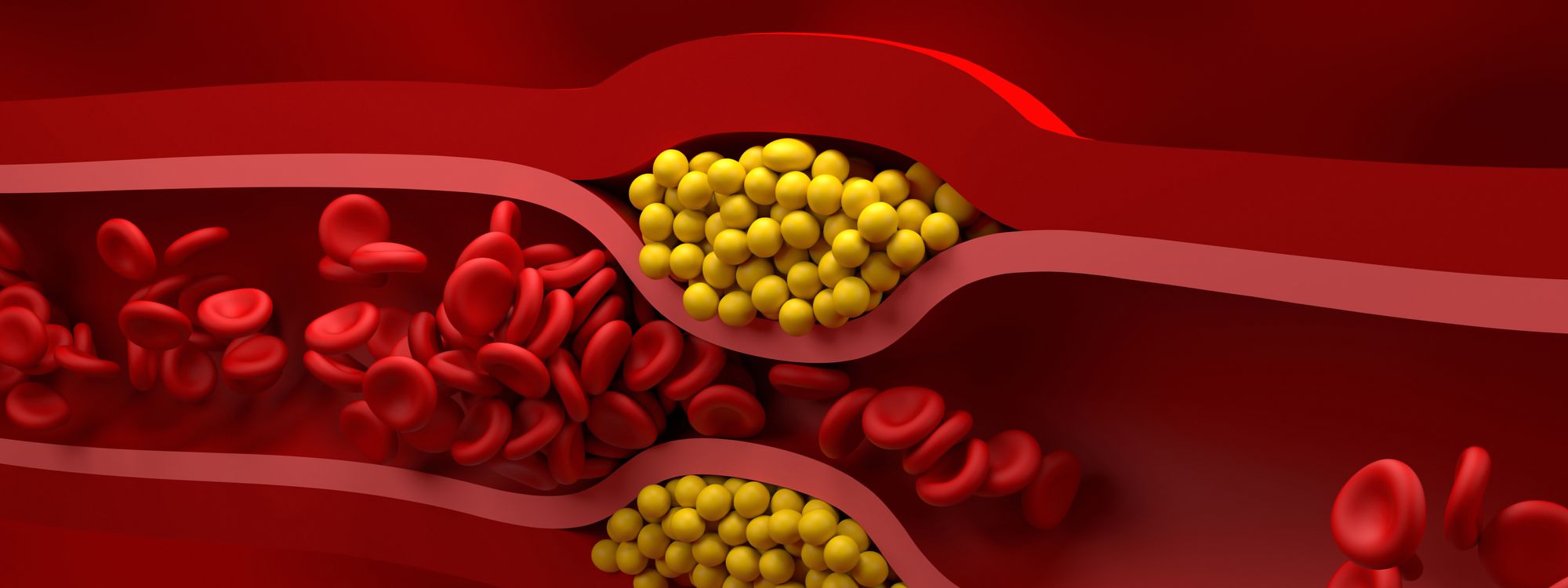 Hypercholesterolemia: Causes, Symptoms, Diagnosis and Treatment