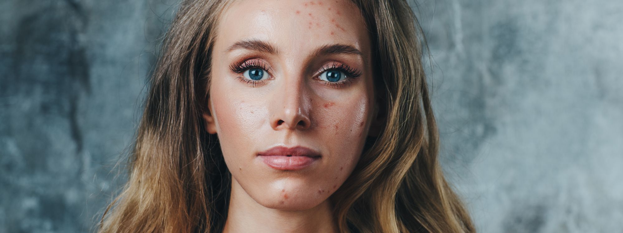 Acne: What it is, Causes, Symptoms and Treatment