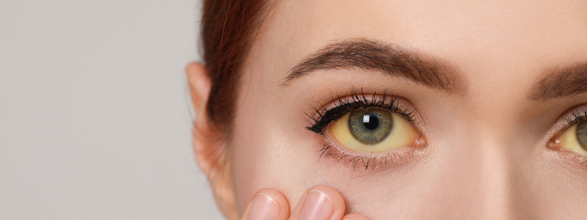 Yellow Eyes: Common Causes