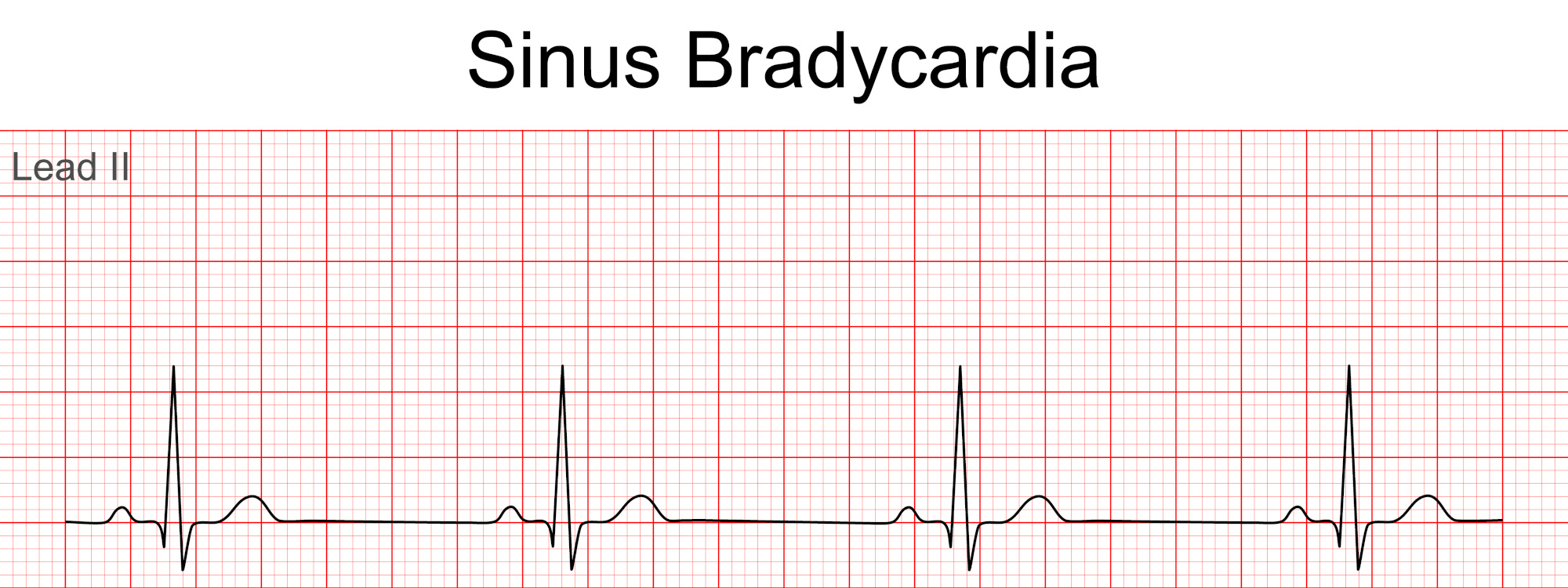 Sinus Bradycardia: Causes, Symptoms, Diagnosis, and Treatment