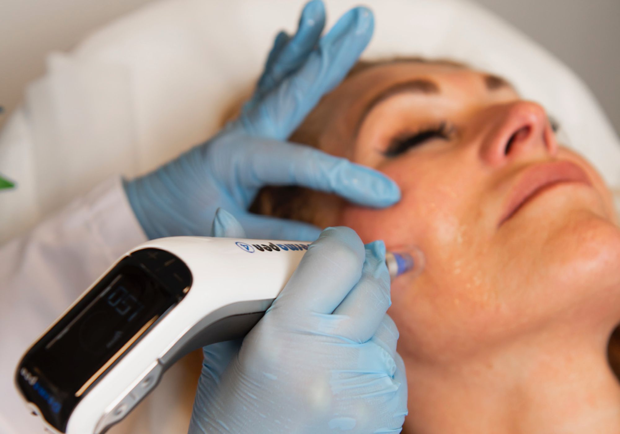 Hva er Microneedling – Dermapen™ behandling?