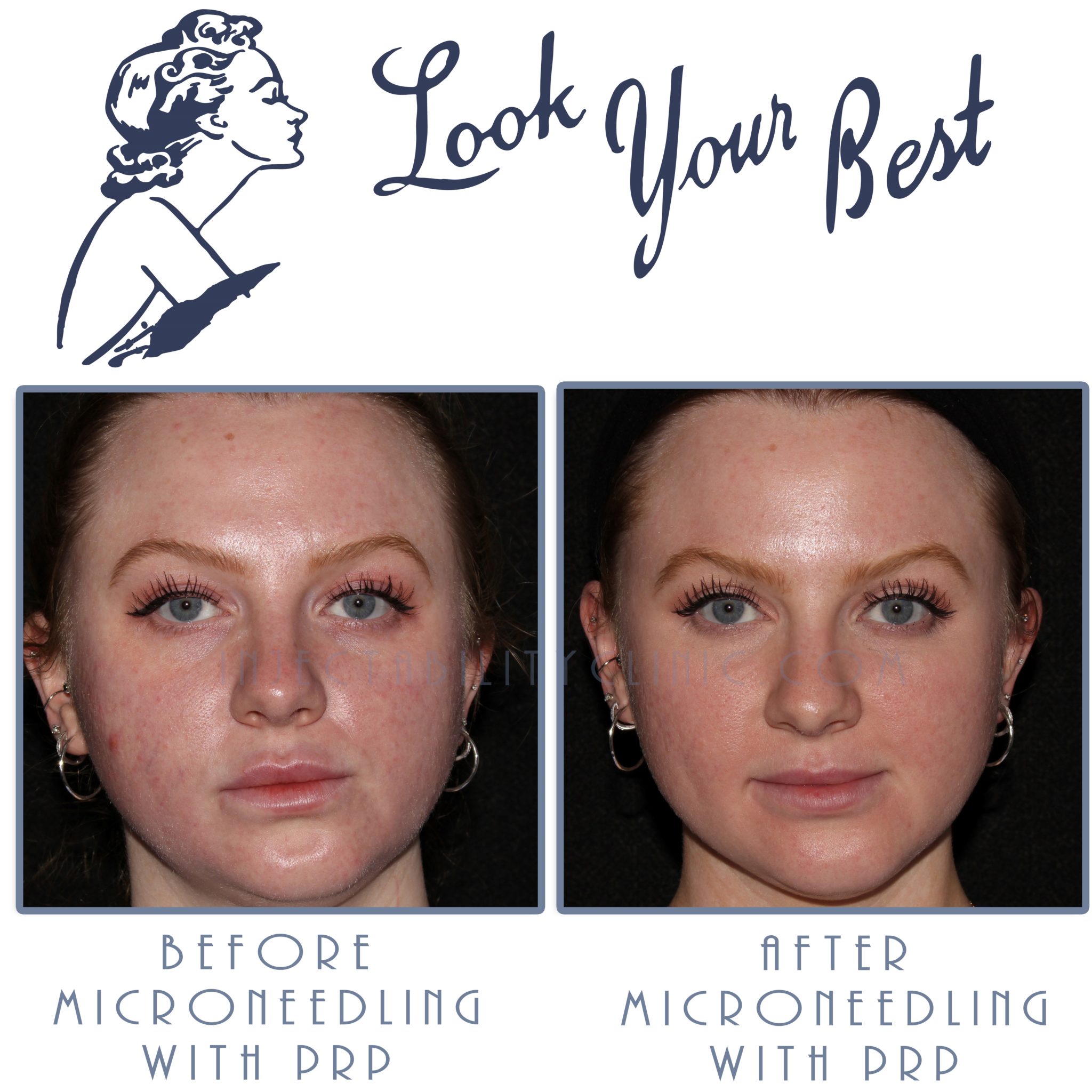 Radiant Rejuvenation: Unveiling the Benefits of PRP with Microneedling