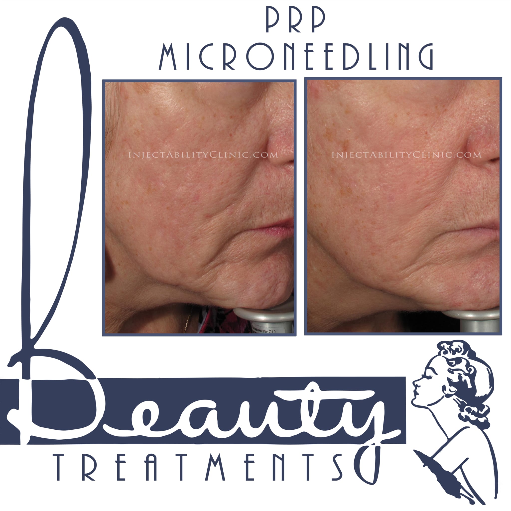 Future-Ready Radiance: Microneedling with PRP for Transformative Skin ...