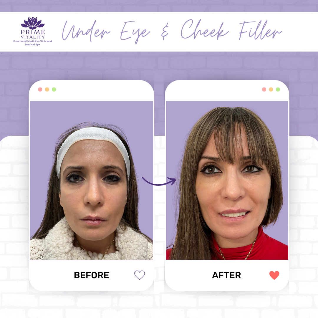 Dermal Fillers | Prime Vitality | Functional Medicine Clinic and ...