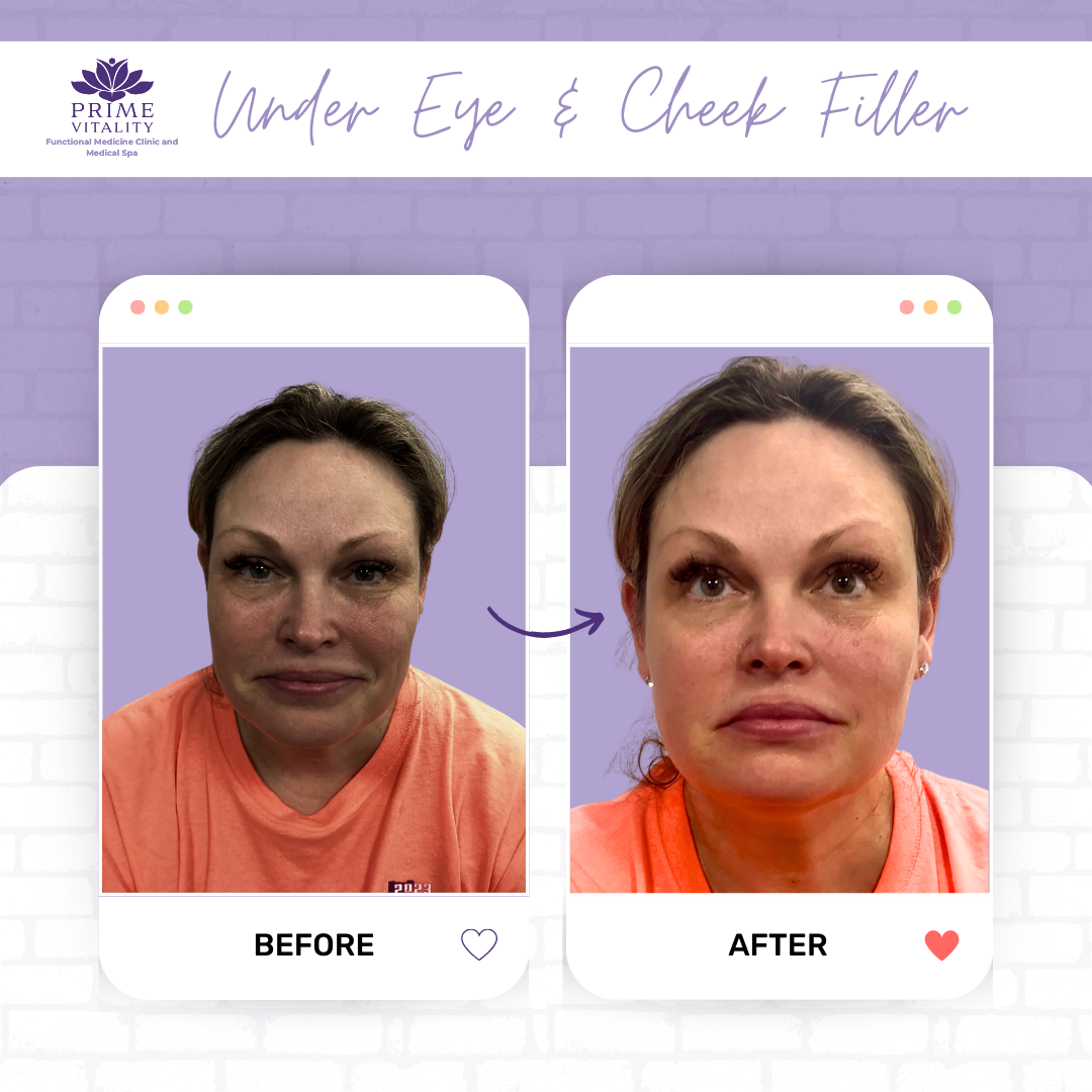 Dermal Fillers | Prime Vitality | Functional Medicine Clinic and ...