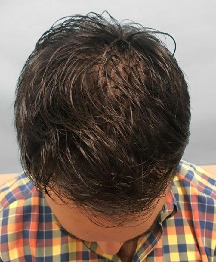Locklab | 3-in-1 Hair Loss Treatment