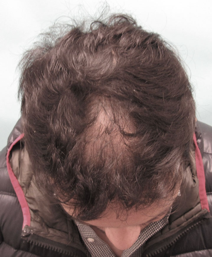 Locklab | 3-in-1 Hair Loss Treatment