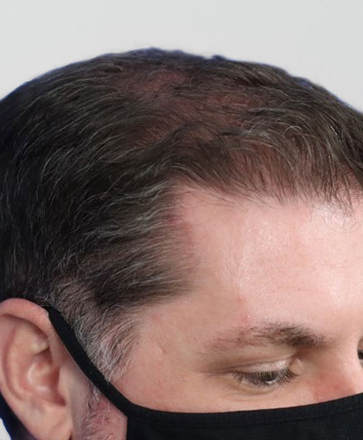 Locklab | 3-in-1 Hair Loss Treatment