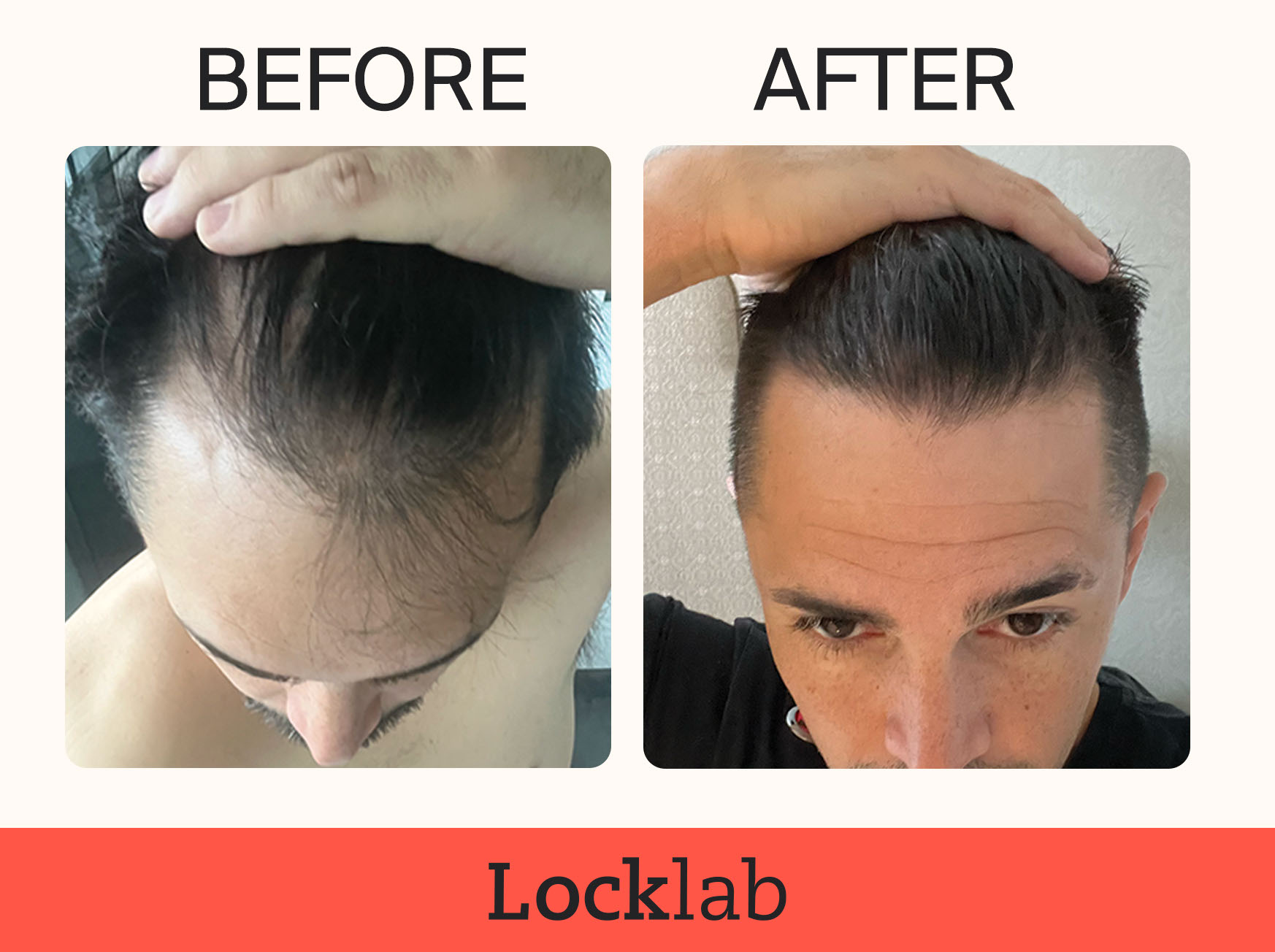 Who is Locklab’s hair regrowth pill for?