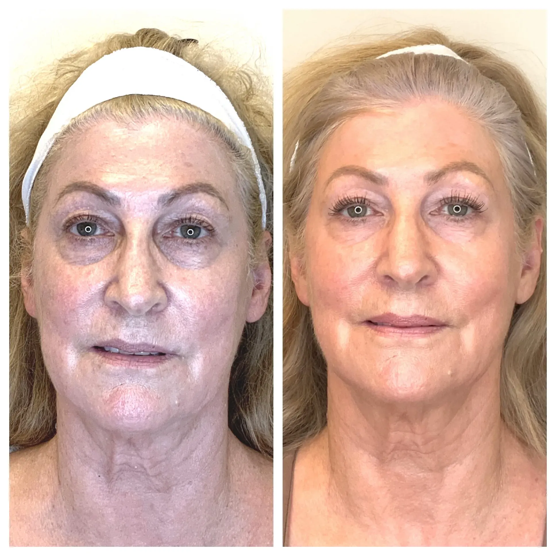 Skin Resurfacing Before and After Gallery | Dr. Connie Hiers Plastic ...