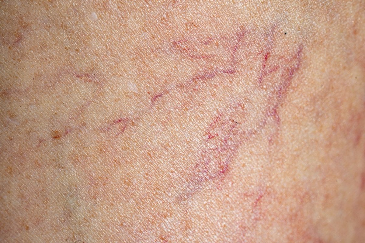 Spider Veins/Broken Capillaries/Cherry Angioma