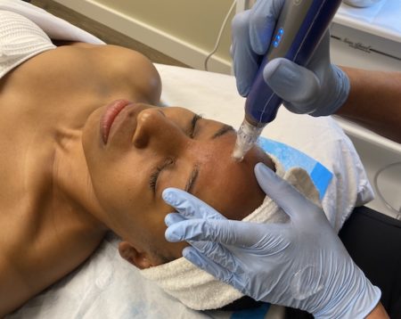 How to Get the Best Micropenning Results | SkinSpirit