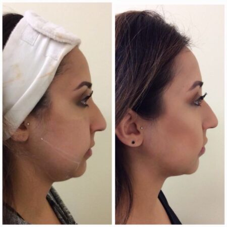 Kybella Fat Reduction | Everything You Need to Know About Kybella