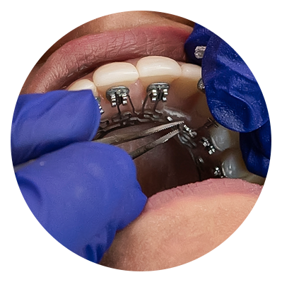 Brava by Brius - The Faster Alternative to Traditional Braces
