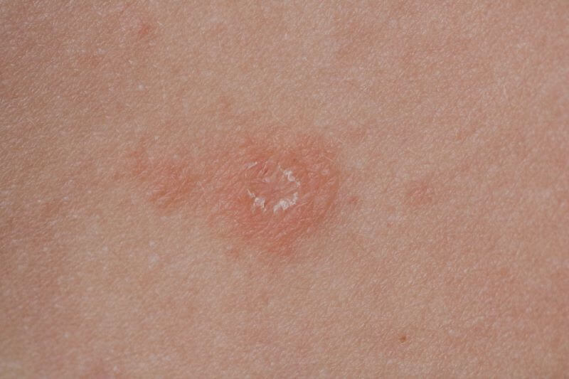 Pityriasis Rosea | Warthan Amir Dermatology Dallas