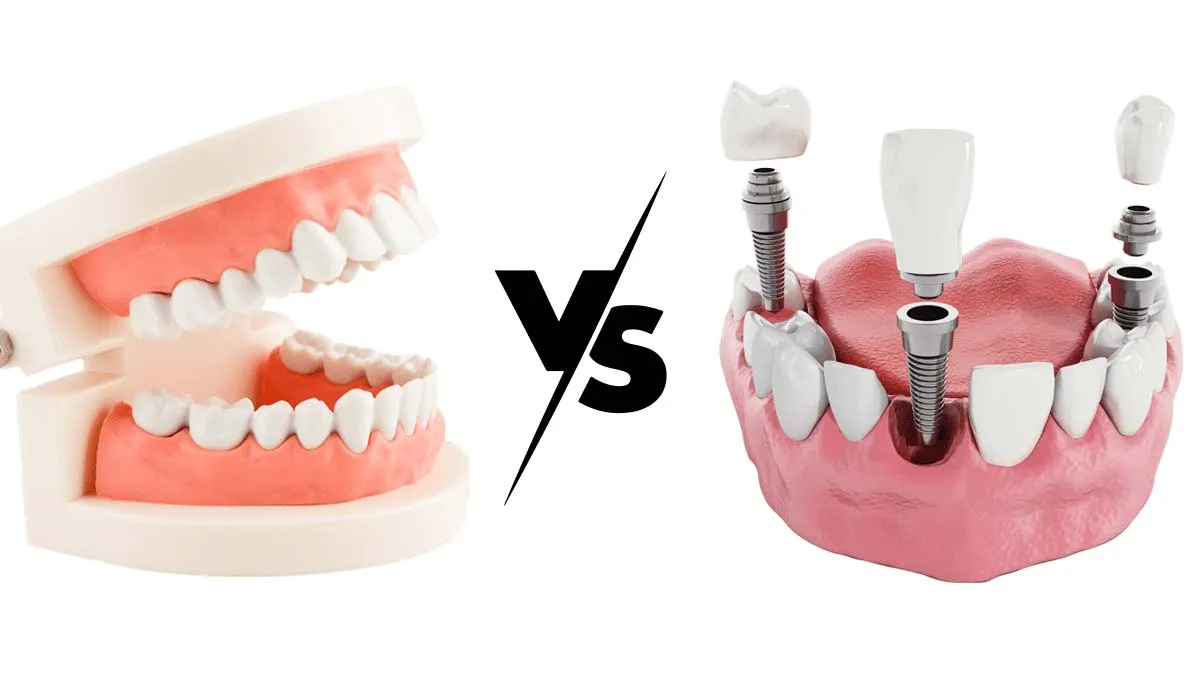 Difference Between Dental Implants and Dentures | Florida Dental ...