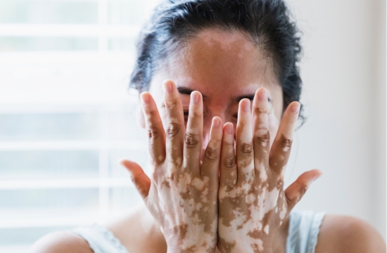 Vitiligo Treatment in Visakhapatnam | Prakrithi Skin, Hair and Laser Clinic